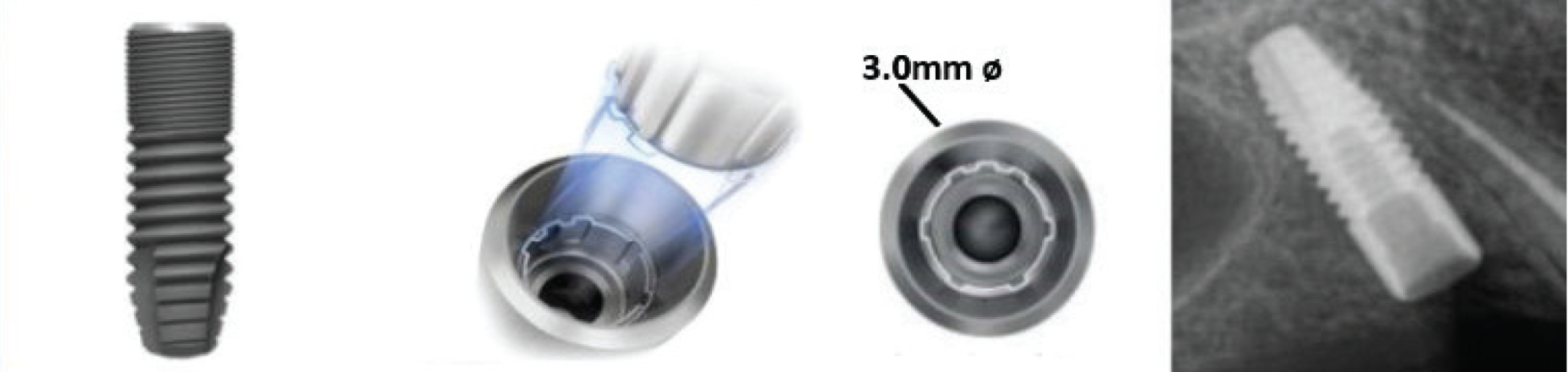 Astra Implant Systems - Swiss NF Metals